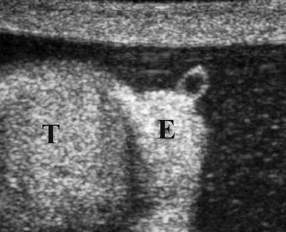 Cystic appendix epididymis: a sonomorphologic study | SpringerLink