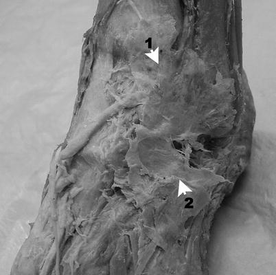Enlarged perforating branch of peroneal artery and extra crural fascia ...
