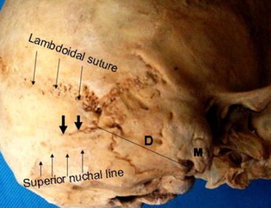The mendosal suture of the occipital bone: occurrence in Indian ...