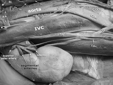 Unusual origin and course of the testicular arteries | SpringerLink