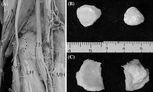 Anatomical study of the fabella, fabellar complex and its clinical ...