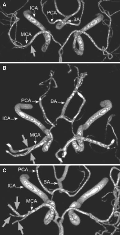 Main anatomical features of the M1 segment of the middle cerebral ...