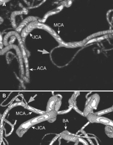 Main anatomical features of the M1 segment of the middle cerebral ...