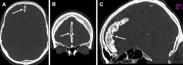 Computed tomographic demonstration of unusual ossification of the falx ...