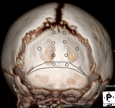 Occipital sutures and its variations: the value of 3D-CT and how to ...
