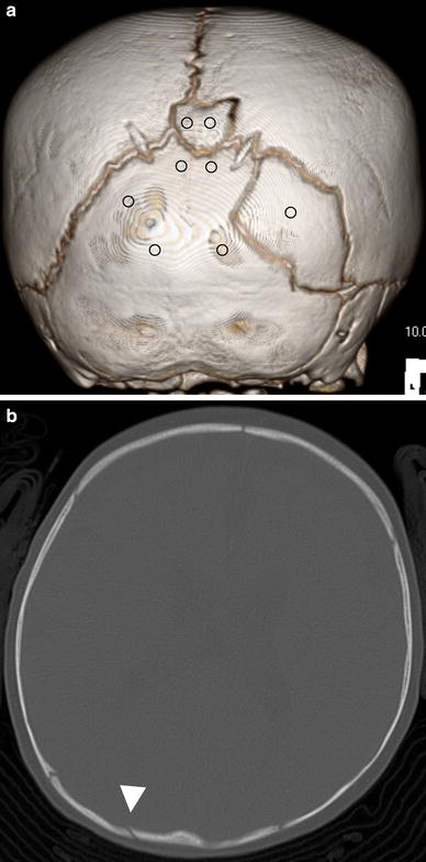 Occipital sutures and its variations: the value of 3D-CT and how to ...