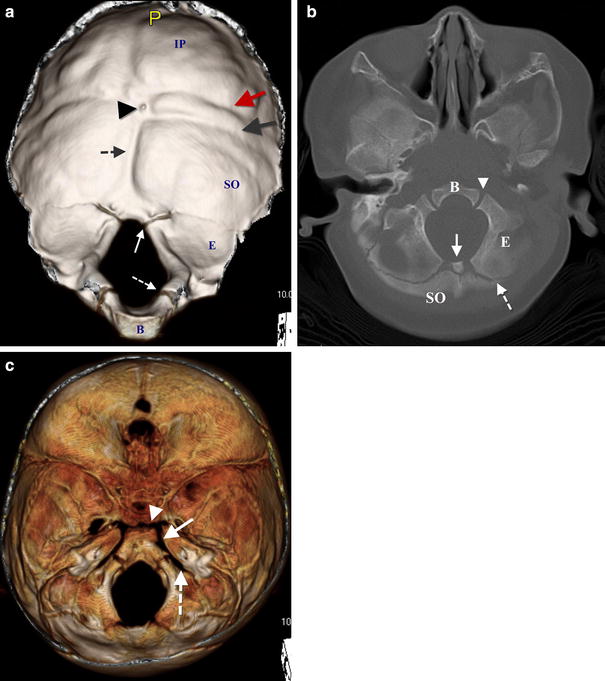 Occipital sutures and its variations: the value of 3D-CT and how to ...