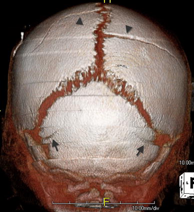 Occipital sutures and its variations: the value of 3D-CT and how to ...
