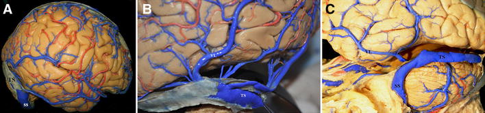 Microsurgical anatomy of the vein of Labbé | SpringerLink