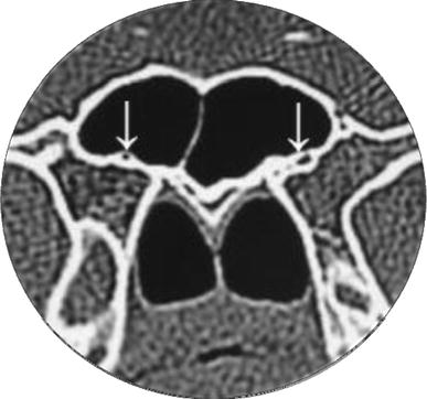 The neglected anatomical and clinical aspects of pterygoid canal: CT ...