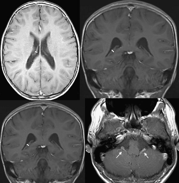 Choroid plexus: normal size criteria on neuroimaging | SpringerLink