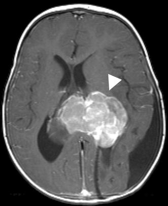 Choroid plexus: normal size criteria on neuroimaging | SpringerLink