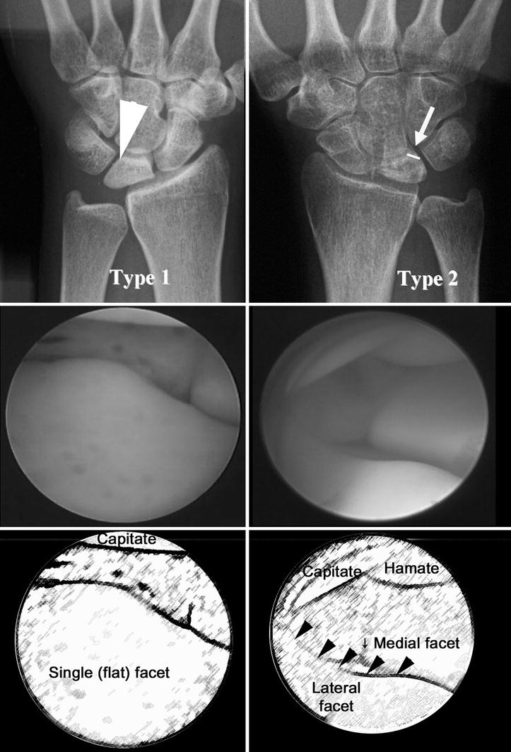 Arthroscopic lunate morphology and wrist disorders | SpringerLink