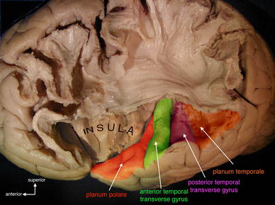 Morphometry and localization of the temporal transverse Heschl’s gyrus ...