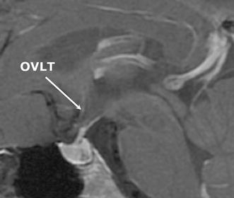 The circumventricular organs of the brain: conspicuity on clinical 3T ...
