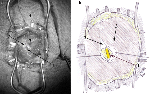 Anatomical basis of transgluteal approach for pudendal neuralgia and ...