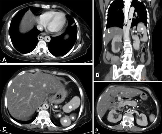 Polysplenia syndrome: a review of the relationship with viscero-atrial ...