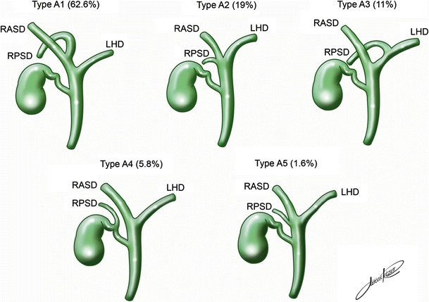 Bile duct confluence: anatomic variations and its classification ...