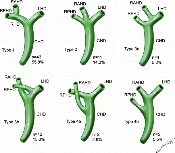 Bile duct confluence: anatomic variations and its classification ...