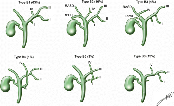 Bile duct confluence: anatomic variations and its classification ...