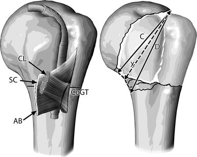 Medial calcar of proximal humeral fracture as landmark in restoration ...
