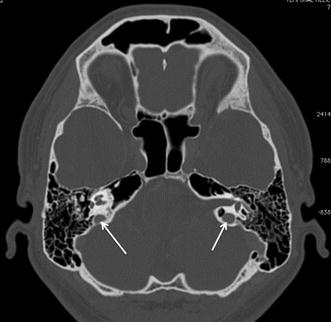 High and dehiscent jugular bulb: clear and present danger during middle ...