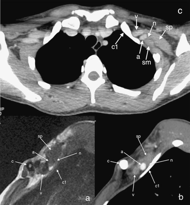 The subclavius posticus muscle: an unusual cause of thoracic outlet ...