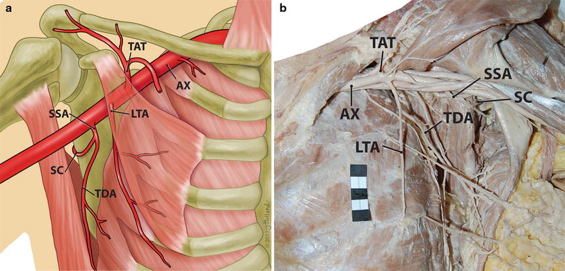 The lateral thoracic artery revisited | SpringerLink