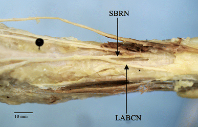 The sensory distribution in the dorsum of the hand: anatomical study ...