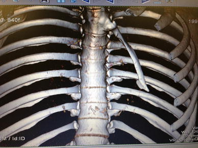 Resection of supernumerary intrathoracic rib using robotic-assisted ...