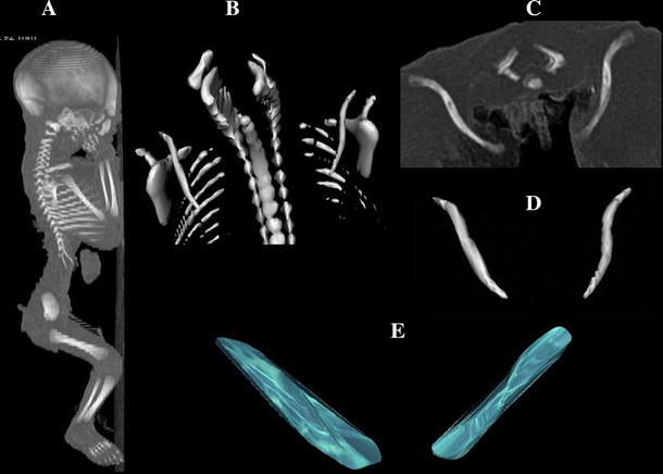 Morphometric study of the two fused primary ossification centers of the ...