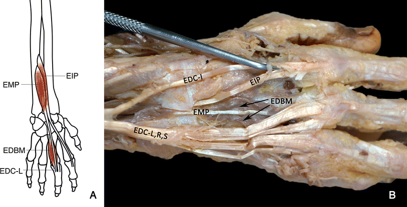 Extensor tendons and variations of the medial four digits of hand: a ...
