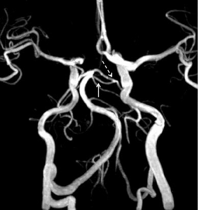 Duplicate origin and extremely long P1 segment of the posterior ...