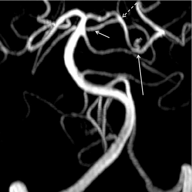 Duplicate origin and extremely long P1 segment of the posterior ...