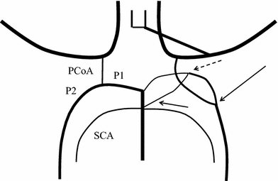 Duplicate origin and extremely long P1 segment of the posterior ...
