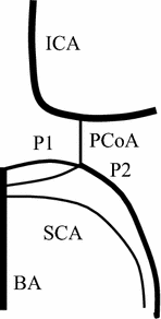 Duplicate origin and extremely long P1 segment of the posterior ...