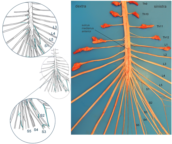 Intraspinal intradural variations of nerve roots | SpringerLink