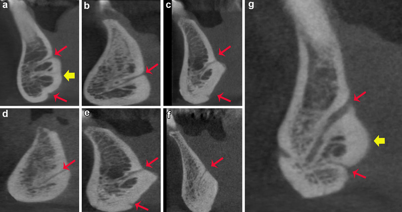 Anatomical landmarks of mandibular interforaminal region related to ...