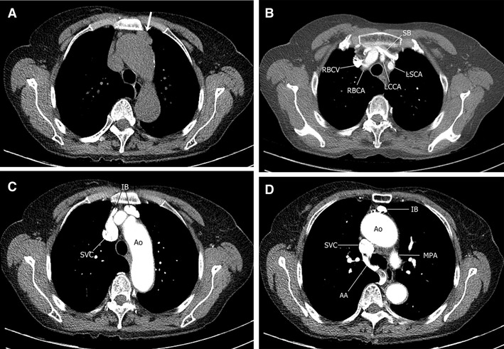 Double left brachiocephalic vein with a preaortic course: a rare ...