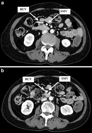 Anatomy of the right colic vein and pancreaticoduodenal branches: a ...