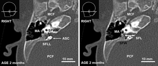 Postnatal development of the subarcuate fossa and subarcuate ...