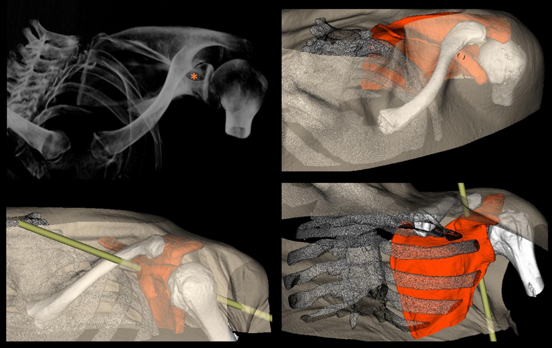 The “coracoid tunnel view”: a simulation study for finding the optimal ...