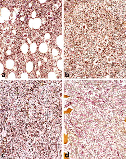 Grade of bone marrow fibrosis is associated with relevant hematological ...