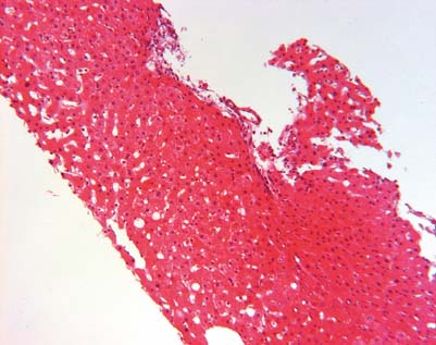 Die Leberbiopsie im Schnittpunkt von klinischer und pathologischer ...