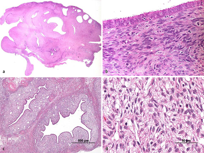 Mesenchymale Uterustumoren | SpringerLink