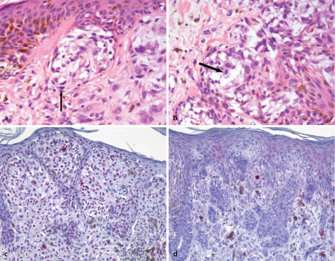 Mitosen bei frühinvasiven malignen Melanomen | SpringerLink
