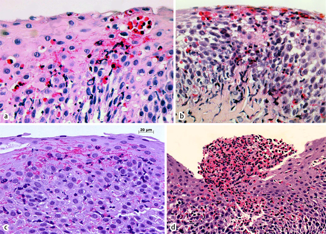 Eosinophile Ösophagitis | SpringerLink