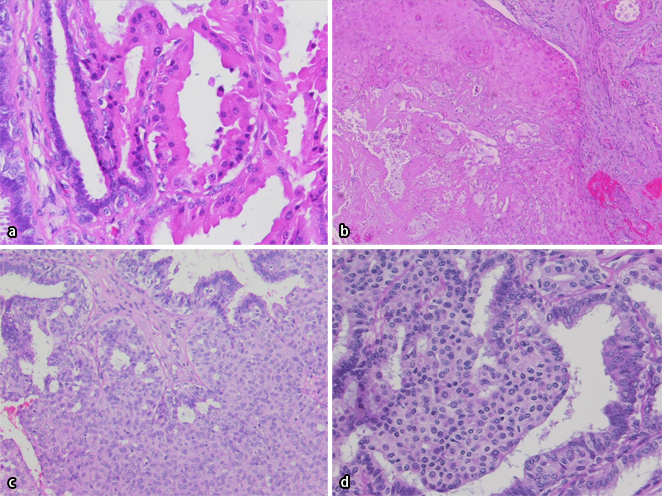 Papilläre Läsionen der Mamma | SpringerLink