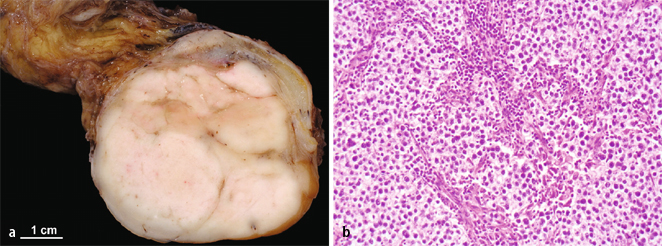 Seminome des Hodens | SpringerLink