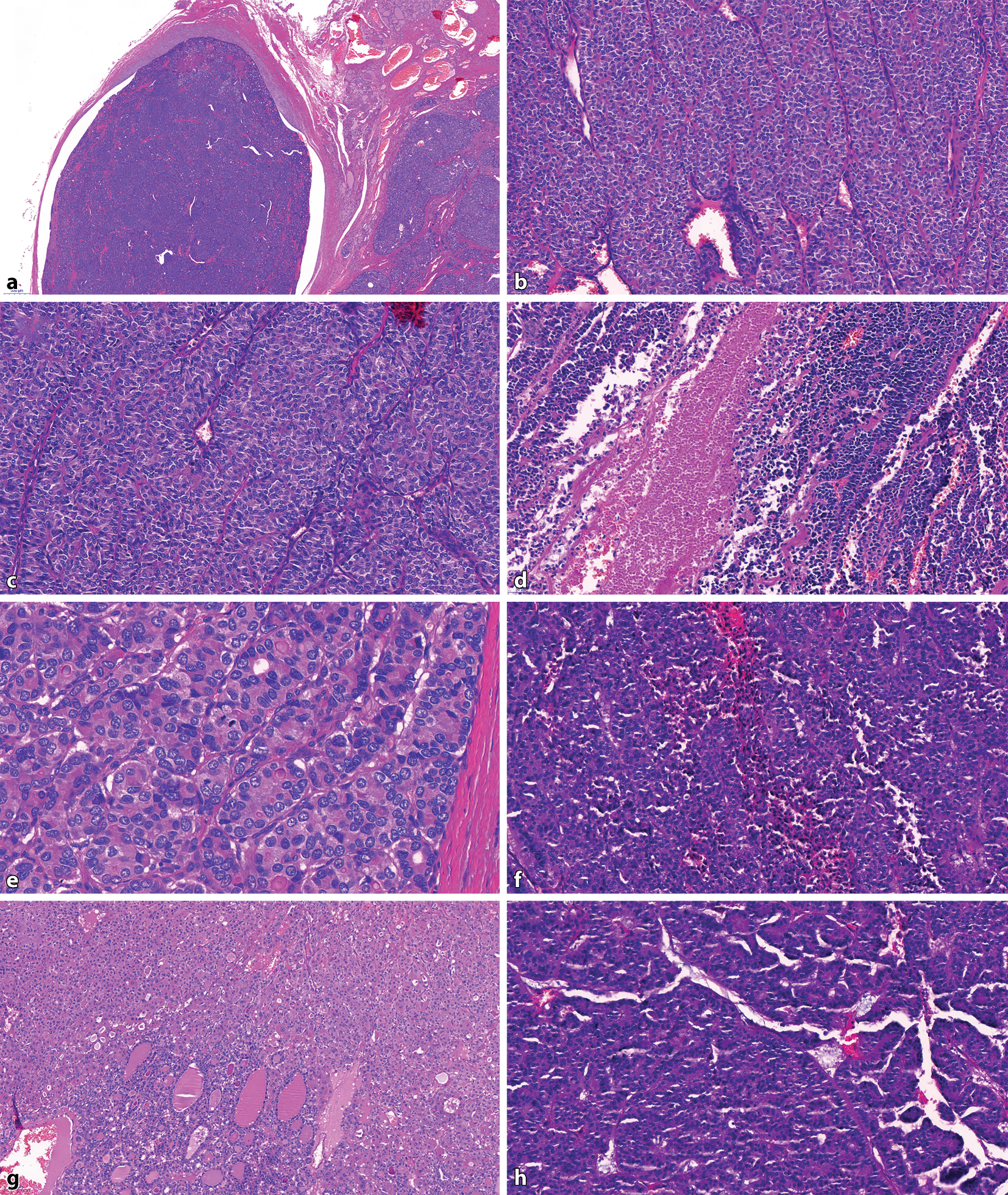 Poorly differentiated thyroid carcinoma | SpringerLink